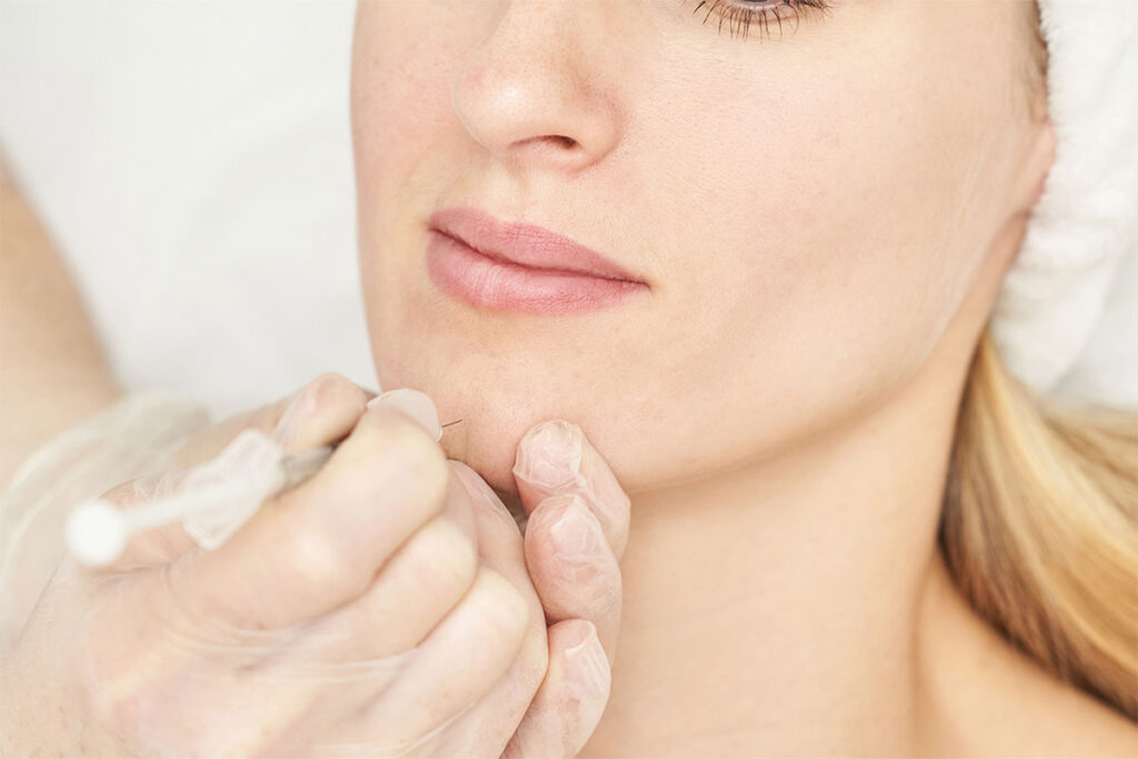 Restylane in Leander and Liberty Hill, TX | Gavino Dermatology